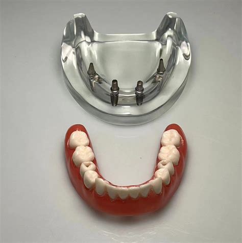 Mandibular Partial Denture