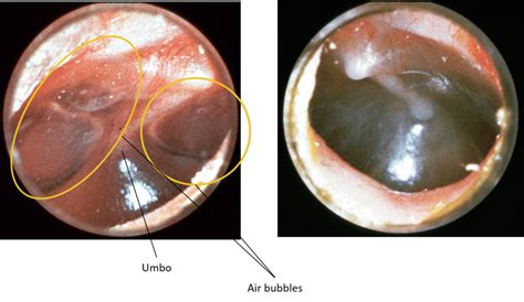 Otitis Externa With Effusion Otitis Media With Effusion How Serous