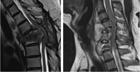 Mri Showing Typical Presentation Of Tuberculosis Of Thoracic And