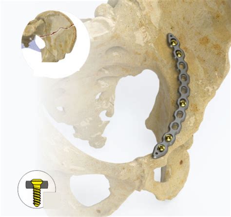 Компрессионная костная пластина для небольшого костного фрагмента 1932 Series Zimed Medical