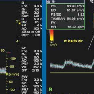 Here We Show The Doppler Waveforms Of A Year Old Woman With
