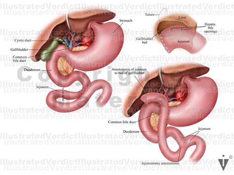Stock Gallbladder Hepaticojejunostomy — Illustrated Verdict