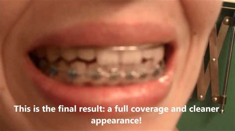 Braces Lips