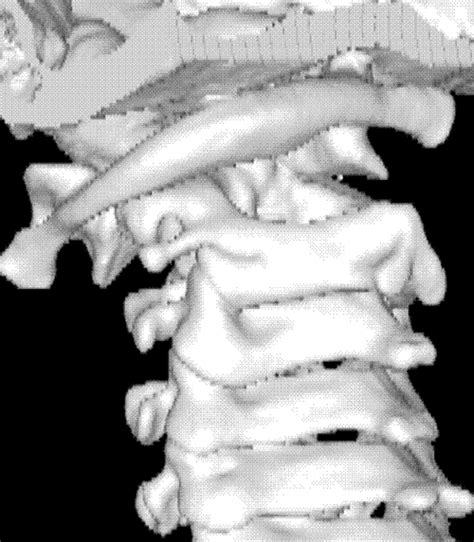 Three Dimensional Cervical Spine Ct Reconstruction Demonstrating