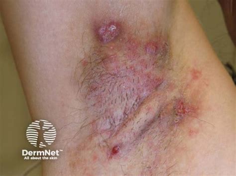 Hidradenitis Suppurativa Of Axilla Image