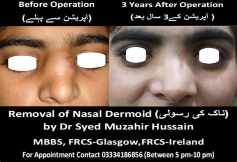 Excision Of Nasal Dermoid Dr Syed Muzahir