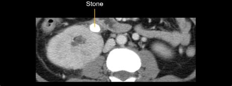Abdominal Ct Renal Infections • Litfl • Radiology Library