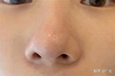 男生鼻子黑头太多，摸起来一粒一粒的，看着恶心巨丑！有什么靠谱好用的去黑头方法？ 知乎