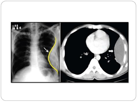 Radiological Imaging Of Pleural Diseases Ppt