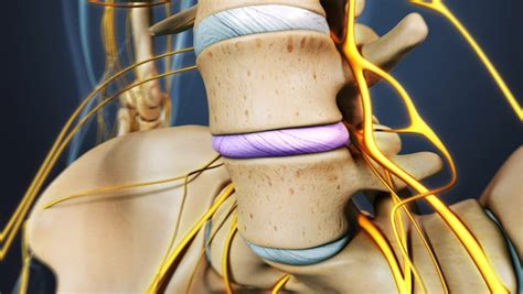 Multilevel Spinal Fusion For Low Back Pain