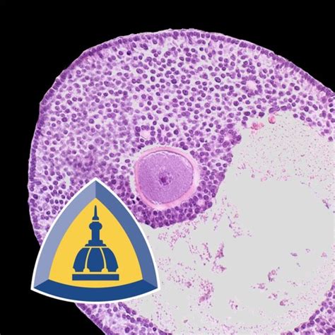 Ovarian Tumor Pathology By Johns Hopkins Mobile Medicine