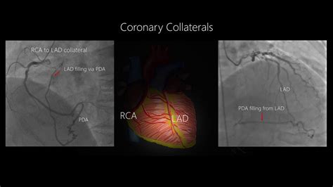What Are Collateral Vessels In The Heart At Chris Stevens Blog