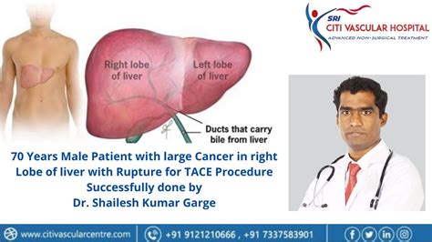 Live Tace Procedure Live Trans Arterial Chemoembolization Liver Hcc