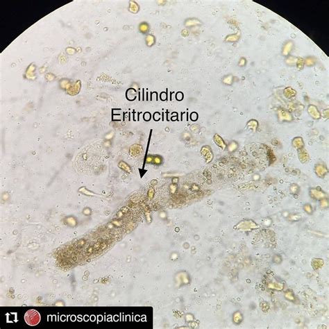 Cilindros Eritrocitarios En Orina Gudangmapa