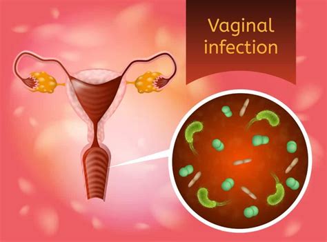 5 Tips To Prevent Yeast Infection While Taking Antibiotics