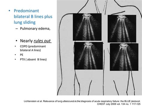 Ultrasonography Fundamentals In Critical Care Lung Ultrasound Pleural