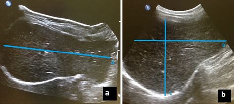 Methods Of Determining The Size Of The Adult Liver Using 2d Ultrasound