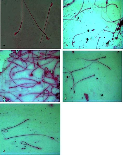 Photomicrograph Showing Evaluation Of Sperm Morphology Profiles By