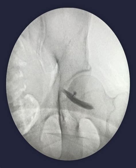 Fluoroscopic Guided Piriformis Injection Dr Marios Moniatis