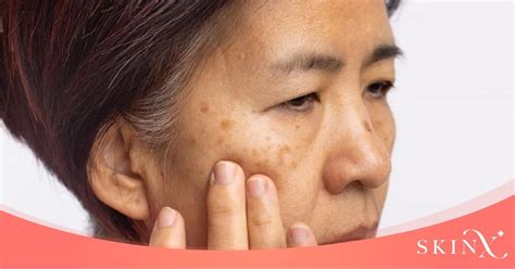 Discovery Pico เครื่องเลเซอร์ Picosecond แก้รอยผิวสุดล้ำจากอิตาลี