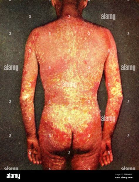 Exfoliative Dermatitis Am Hodensack