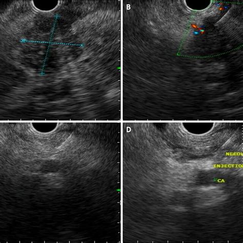 Celiac Plexus Neurolysis A Pancreatic Ductal Adenocarcinoma Located