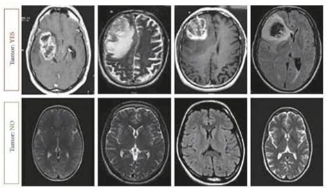 Figure 2 From Automatic Brain Tumor Detection And Classification On Mri