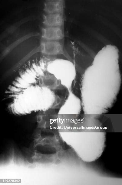 Barium Contrast Photos And Premium High Res Pictures Getty Images