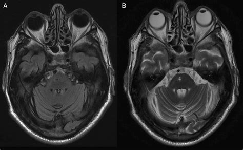 Lesión Cerebral Evidenciada Por Rmn En Esclerosis Lateral Amiotrófica Neurología Argentina