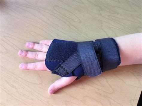 Splinting Abc Pediatric Therapy