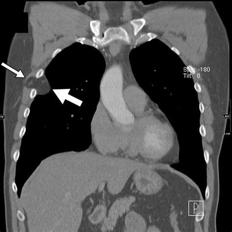 Fat Containing Lesions In Adult Thoracic Imaging Ajr