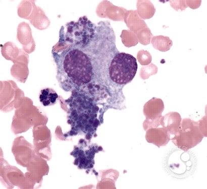 Bare Megakaryocyte