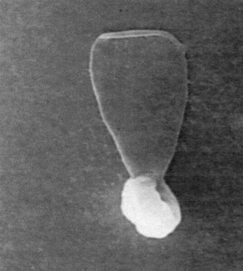 Sperm Tail Stump Defect 01 In Cows Bovis Vetlexicon
