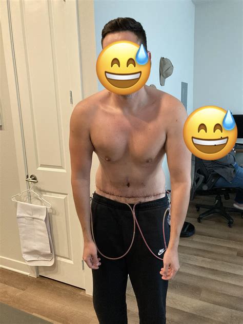 6 Days Post Op Update Rtummytucksurgery