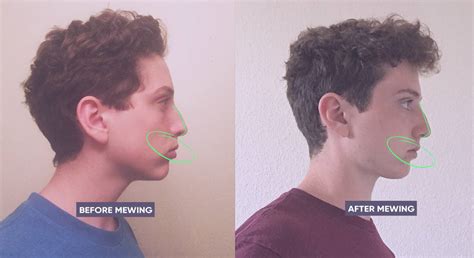 How To Get Rid Of A Pointy Chin If Its Too Visible To Your Liking