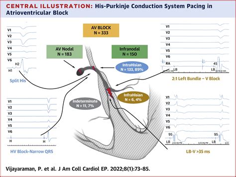 Pacing For Atrioventricular Conduction System Disease