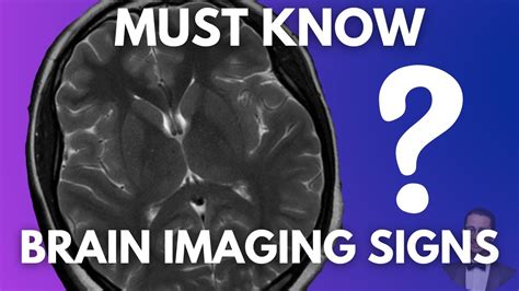 How To Recognise These Common Neuro Radiological Findings Youtube