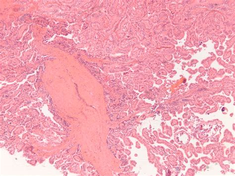 Choroid Plexus Medcbl Inc