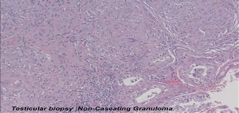 A Rare Case Report Of Bilateral Testicular Masses As An Init