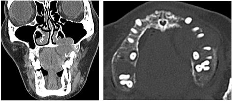Applied Sciences Free Full Text Tumor Induced Osteomalacia As A