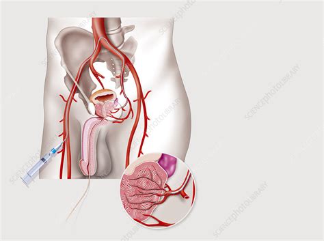 Prostatic Artery Embolization Stock Image C029 8076 Science Photo Library