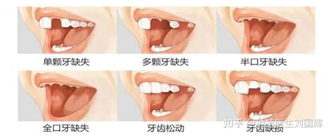 种牙后多久可以吃东西？这四点要注意 知乎