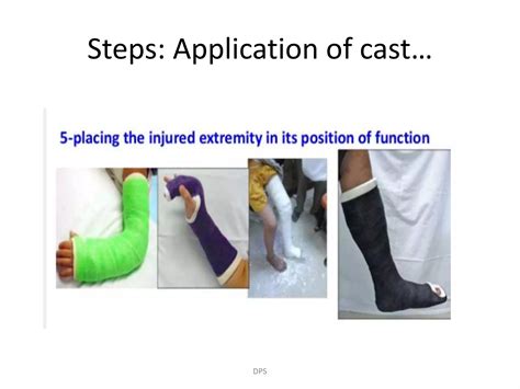 Principles Of Splints And Casts In Orthopaedics By Dr D P Swami Pptx