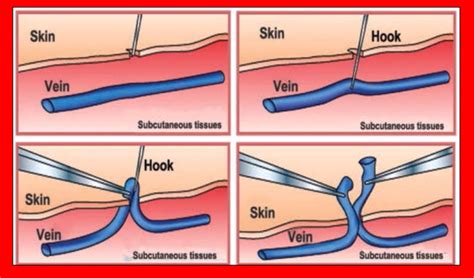 What Is Phlebectomy Varicose Vein Treatments