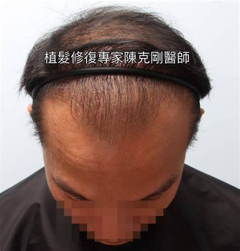 植髮皇帝陳克剛 整形外科醫師 植髮重視的是醫師和團隊的經驗以及技術，不是選了貴的就一定會成功。這是其他診所arta