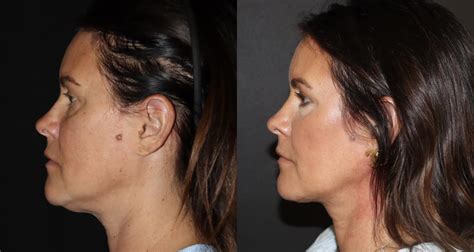 Submental Liposuction Before And After Gallery Cc Plastic Surgery