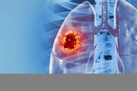 Non Small Cell Lung Cancer Florida Lung Asthma And Sleep Specialists