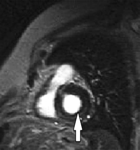Late Gadolinium Enhancement On Cardiac Magnetic Resonance Imaging Download Scientific Diagram