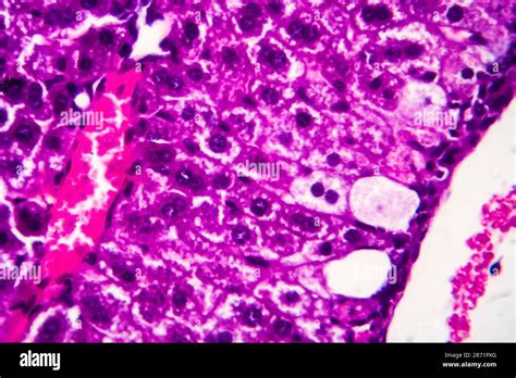 Histopathology Of Acute Hepatitis Light Micrograph Photo Under