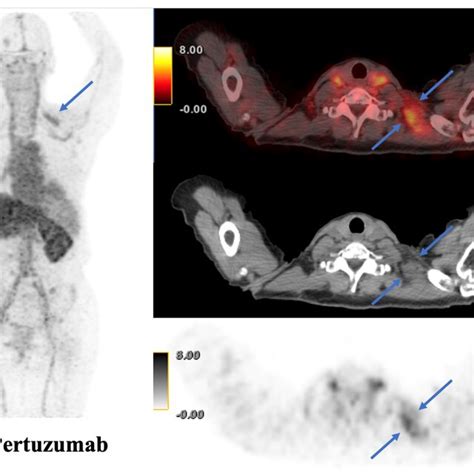 This Is A 43 Year Old Female With Left Breast Invasive Ductal Carcinoma